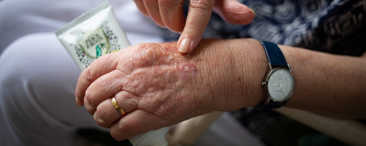 Artrite Reativa Tratamento Da Artrite Psoriásica Reumatologia